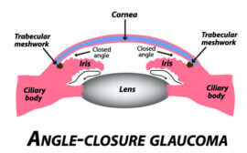 Glaucoma Santa Barbara | Glaucoma Surgery Ventura | Paveloff